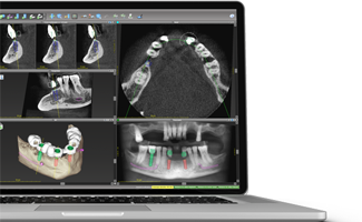 Planification implantaire Dental Concept Nice