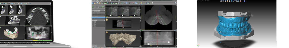Planification implantaire Dental Concept Nice
