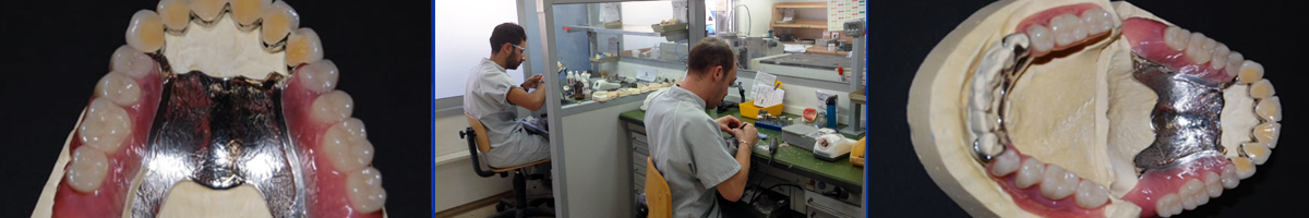 Prothèses combinées - Laboratoire Dental Concept Nice